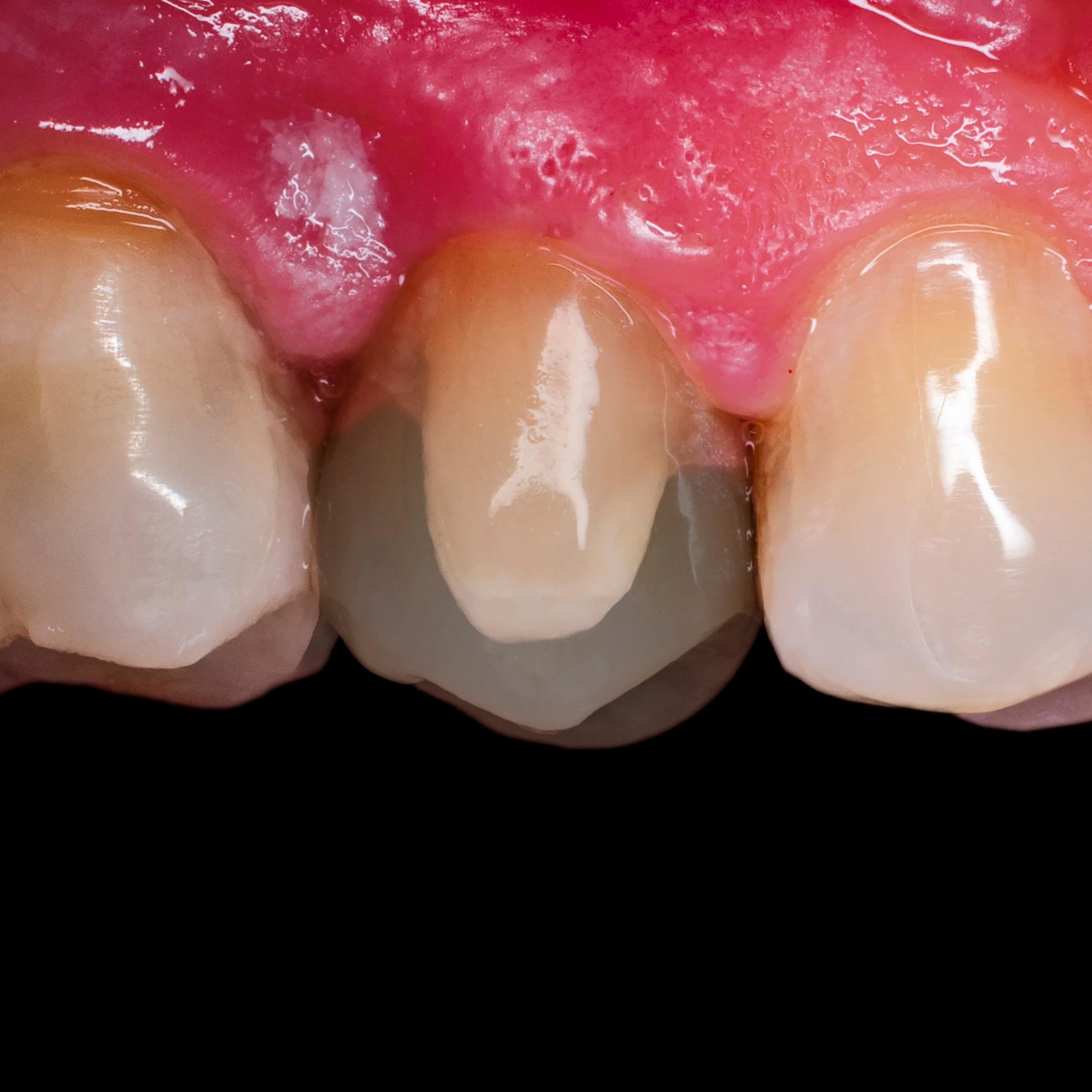 Why You Need a Temporary Restoration: Key Benefits Explained