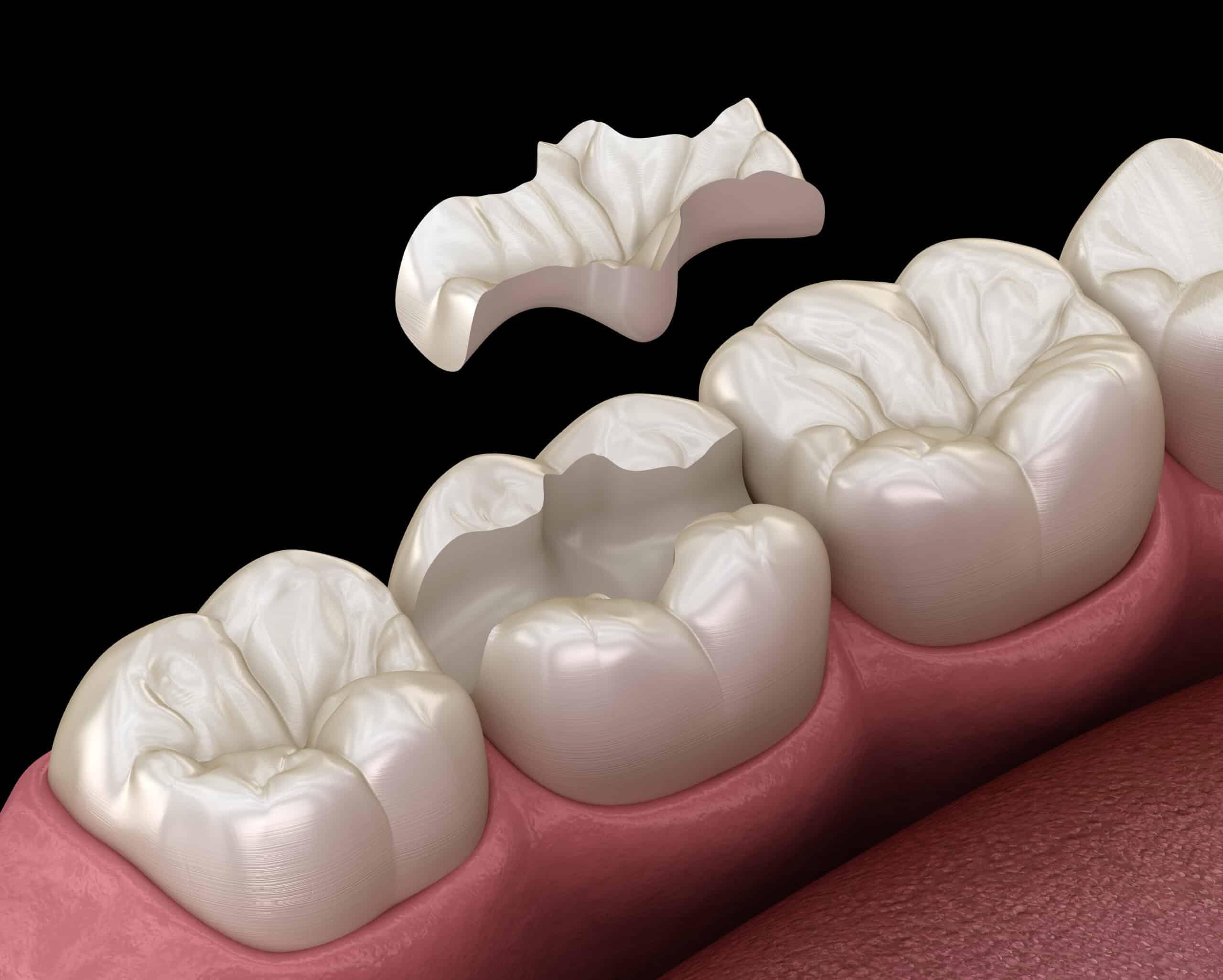 Direct vs. Indirect Dental Restorations in Palm Beach Gardens, FL